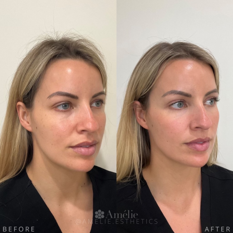 Best PRF Injection Services in Tigard, OR and Vancouver, WA