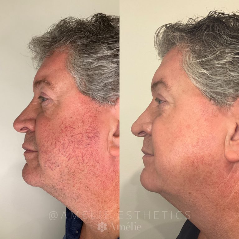 BBL Photofacial - Amelie Med Spa