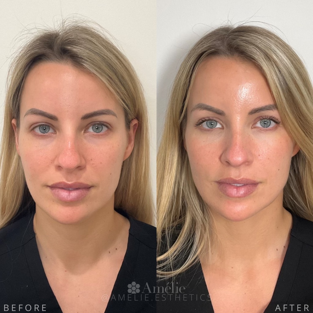 My Experience With Sculptra Amelie Med Spa