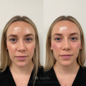 PRF EZ Gel - Amelie Med Spa